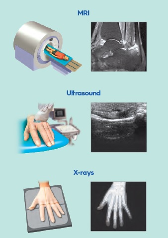 Rheumatoid Arthritis - Articles | Dis-Chem
