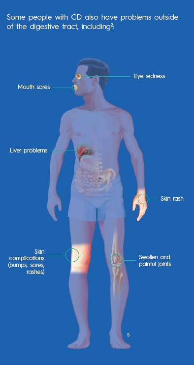 Crohn's Disease - Articles | Dis-Chem