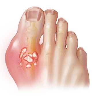 Chronic Gout - Articles | Dis-Chem